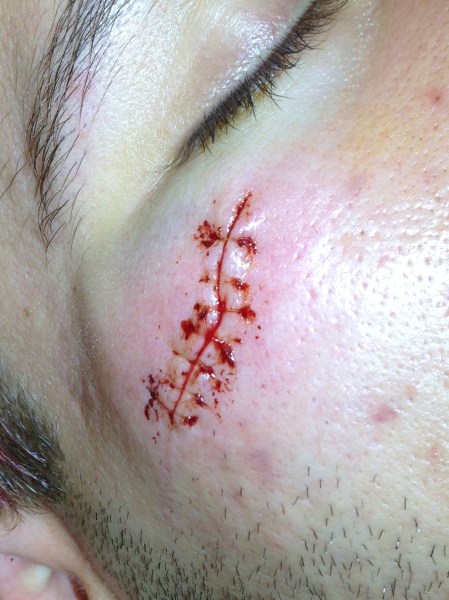 Absorbable Sutures – Closing the Gap