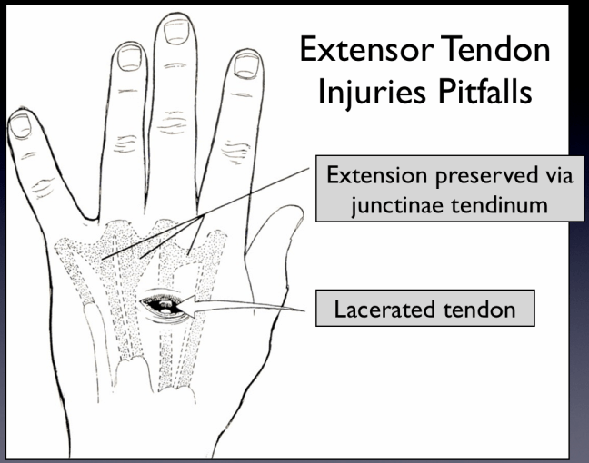 Extensor Tendon Injury Pitfalls – Closing the Gap