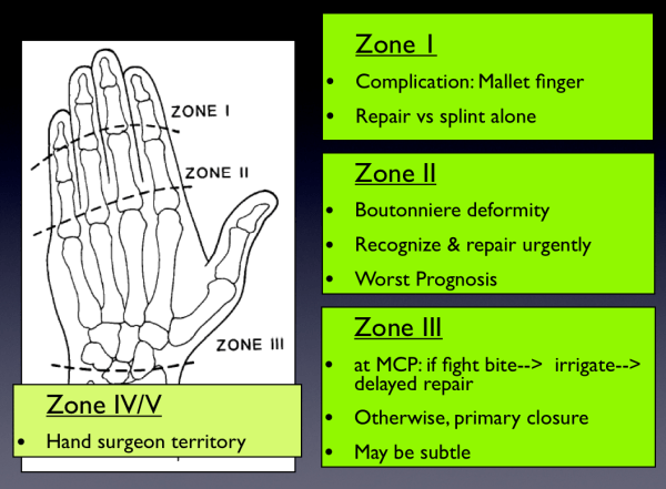 Hand Zones – Closing the Gap