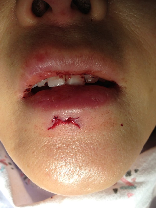 Layered Closure – Closing the Gap