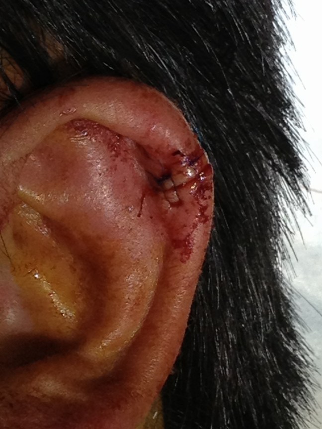 Ear Lacerations, Part II – Closing the Gap