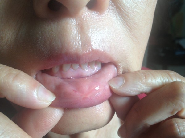 Layered Closure – Closing the Gap