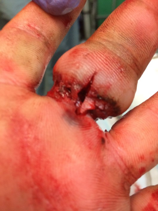 Ring Tourniquet Syndrome – Closing the Gap