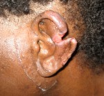 Ear Lacerations, Part I – Closing the Gap