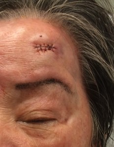 Vascular Injuries, Part II: Ligation Techniques – Closing the Gap