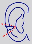 Ear Lacerations, Part I – Closing the Gap