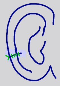 Ear Lacerations, Part I – Closing the Gap