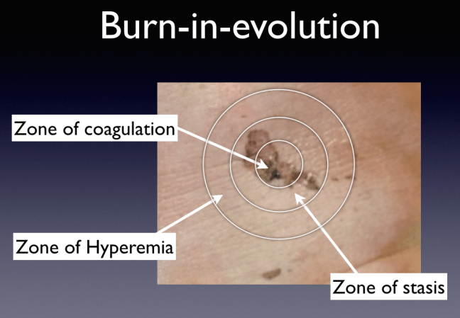 Part I: Injury Grading – Closing the Gap