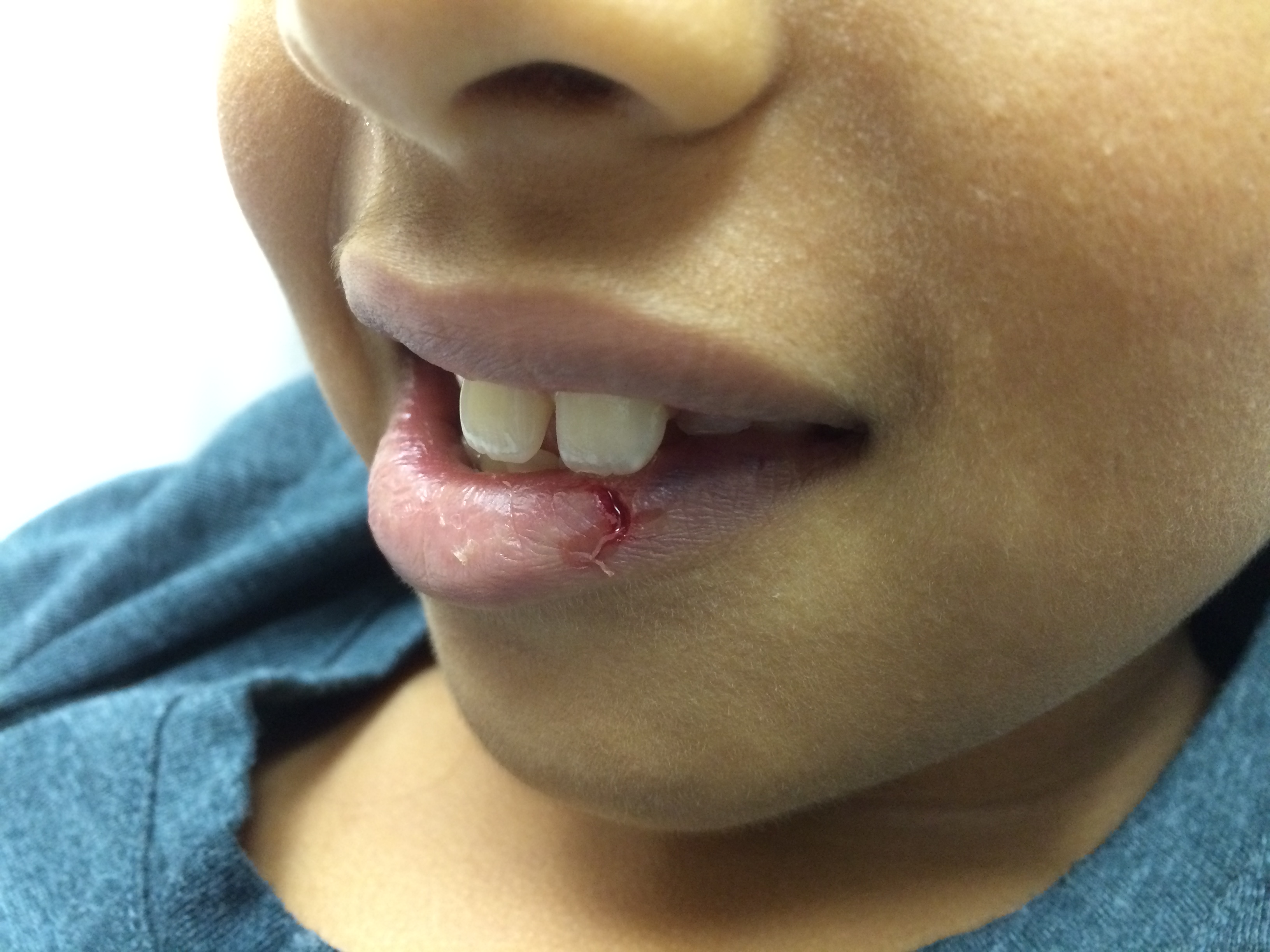 Lip Lacerations, Part II – Closing the Gap