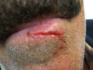 Lip Lacerations, Part I – Closing the Gap