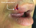 Lip Lacerations, Part II – Closing the Gap