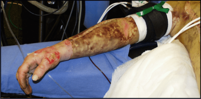 Part V: Escharotomy – Closing the Gap