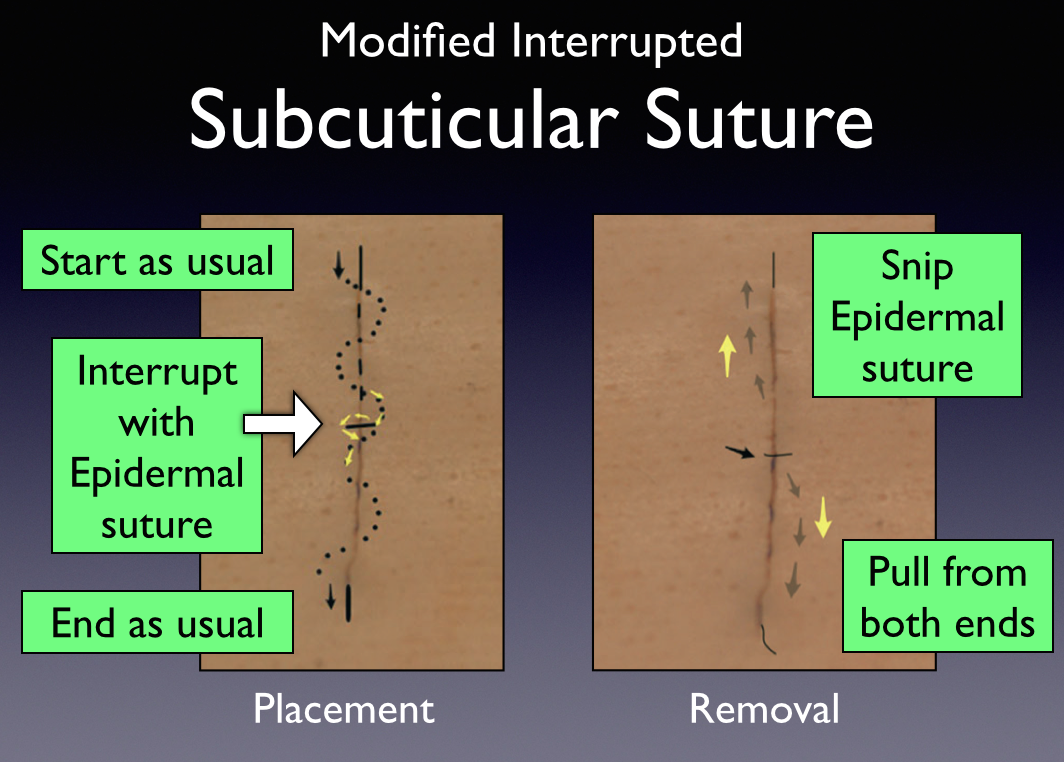 Subcuticular Suturing Pearls – Closing the Gap