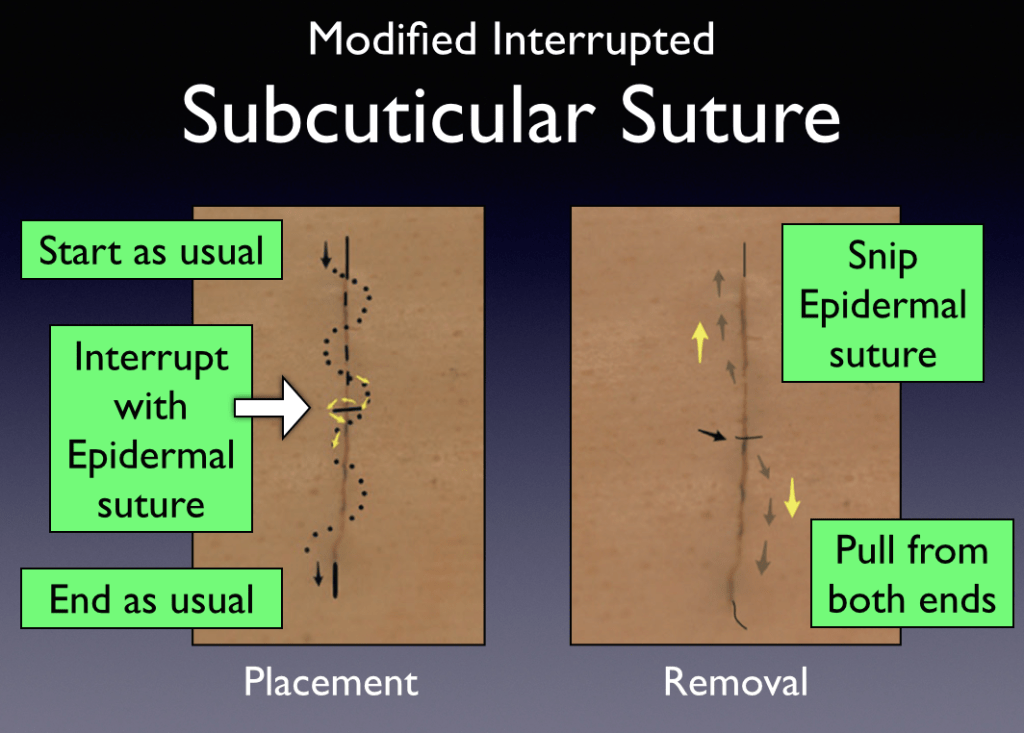Subcuticular Suturing Pearls – Closing the Gap
