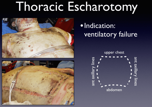 Part V: Escharotomy – Closing the Gap