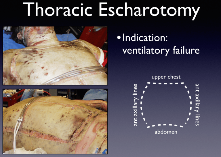 Part V: Escharotomy – Closing the Gap