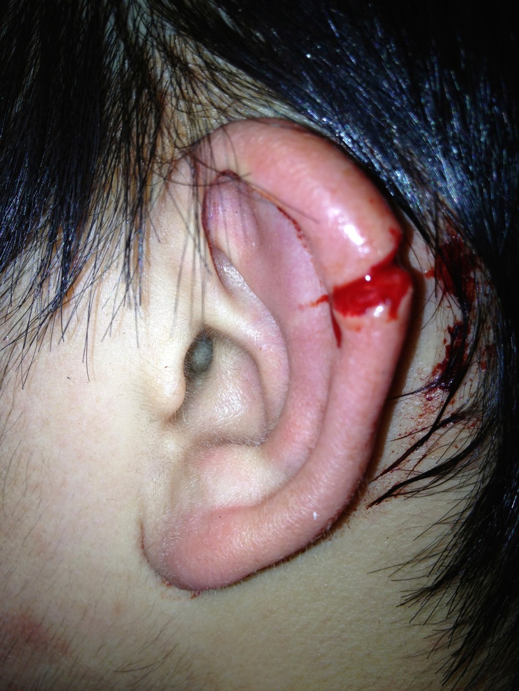 Ear Lacerations, Part II – Closing the Gap