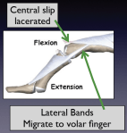 Extensor Tendon Injuries: PIP & Elson’s Test – Closing the Gap