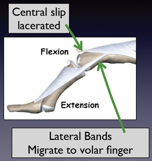 Extensor Tendon Injuries: PIP & Elson’s Test – Closing the Gap