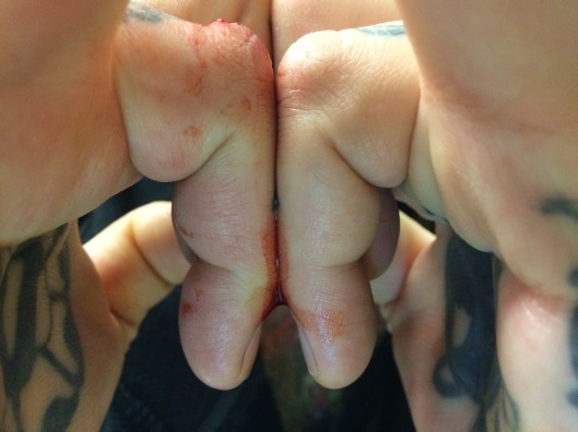 Extensor Tendon Injuries: PIP & Elson’s Test – Closing the Gap