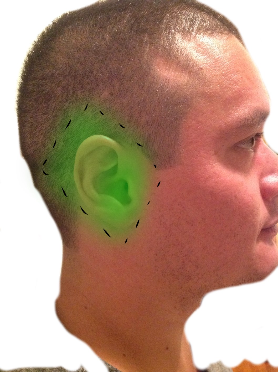 Field Block of the Ear – Closing the Gap