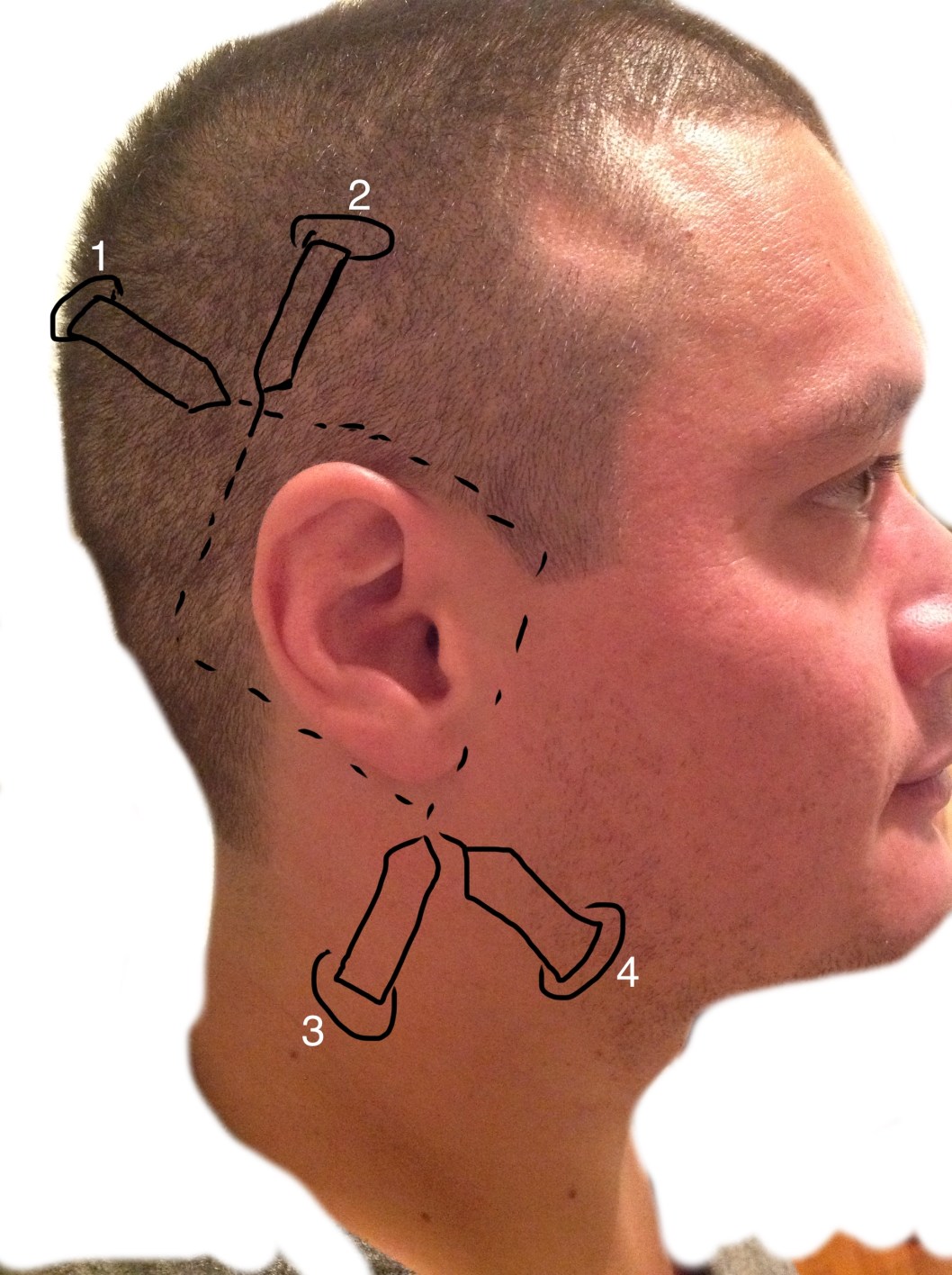 Field Block of the Ear – Closing the Gap