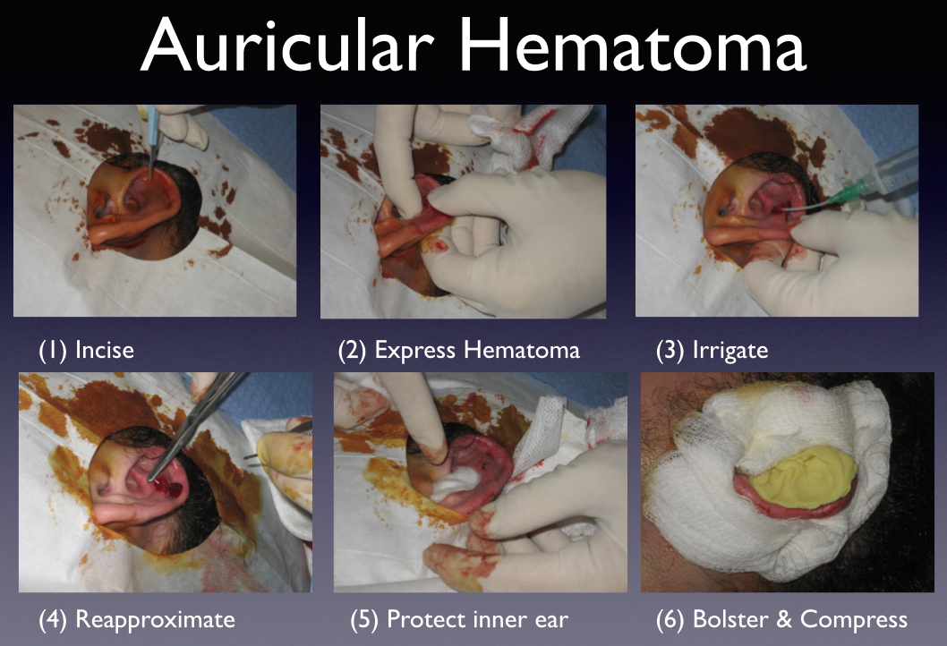 Ear Lacerations, Part II – Closing the Gap