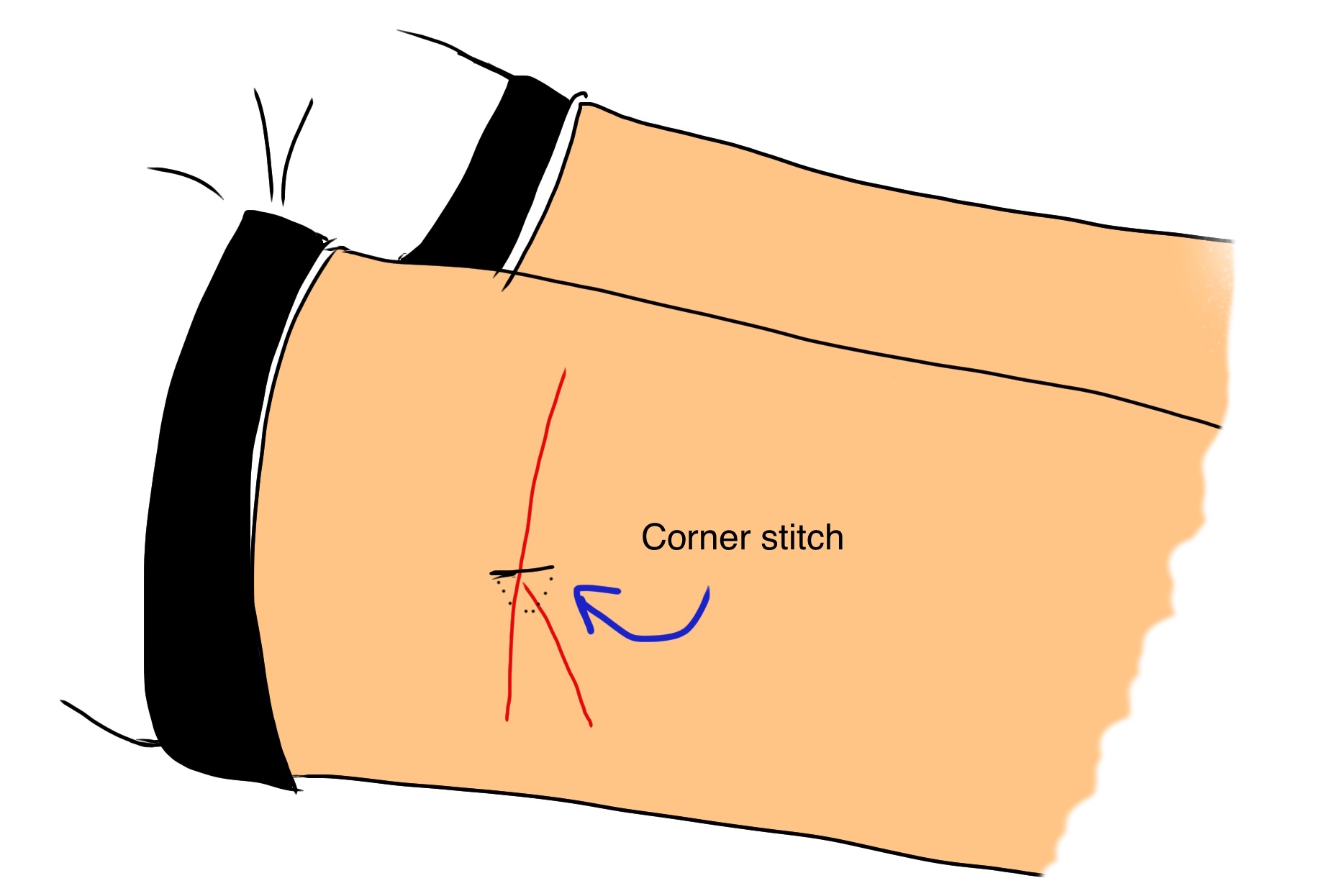 Preventable Lacerations: Epipen Auto-Injectors, Part I – Closing the Gap