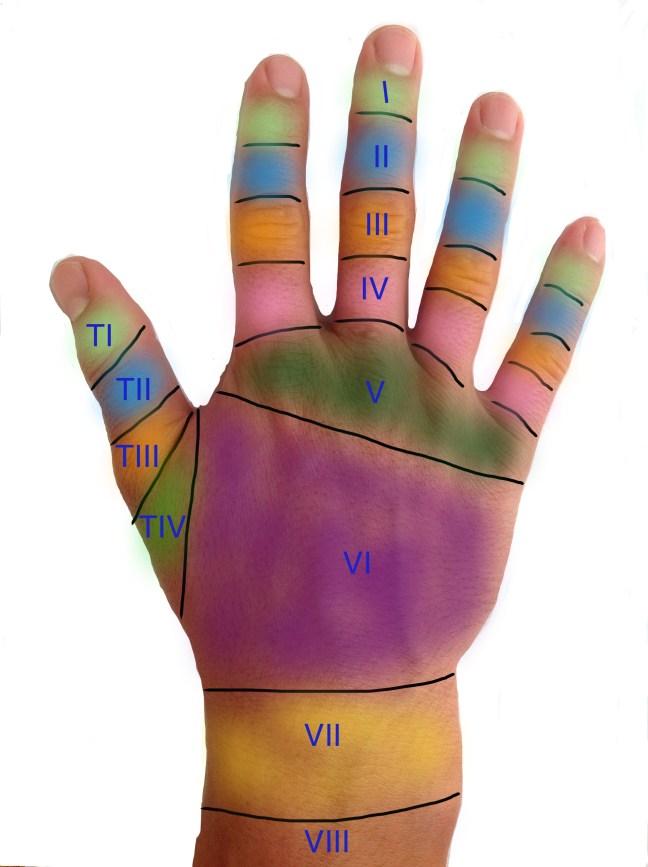 Extensor Tendon Injuries, Part II – Closing the Gap