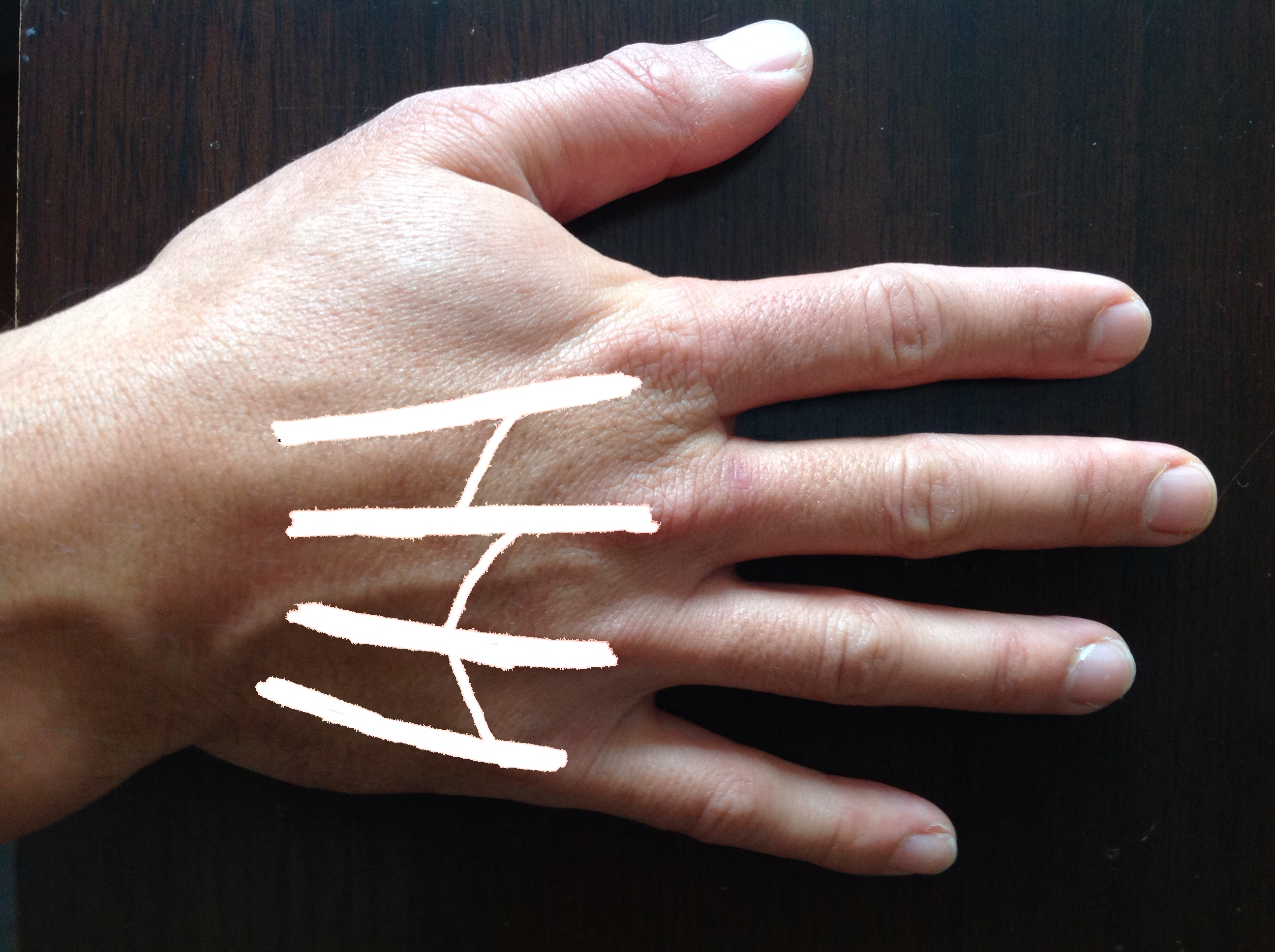 Extensor Tendon Lacerations, Part I – Closing the Gap