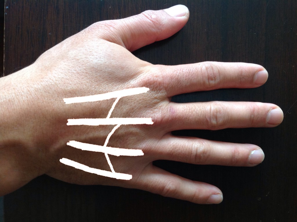 Extensor Tendon Lacerations, Part I – Closing the Gap