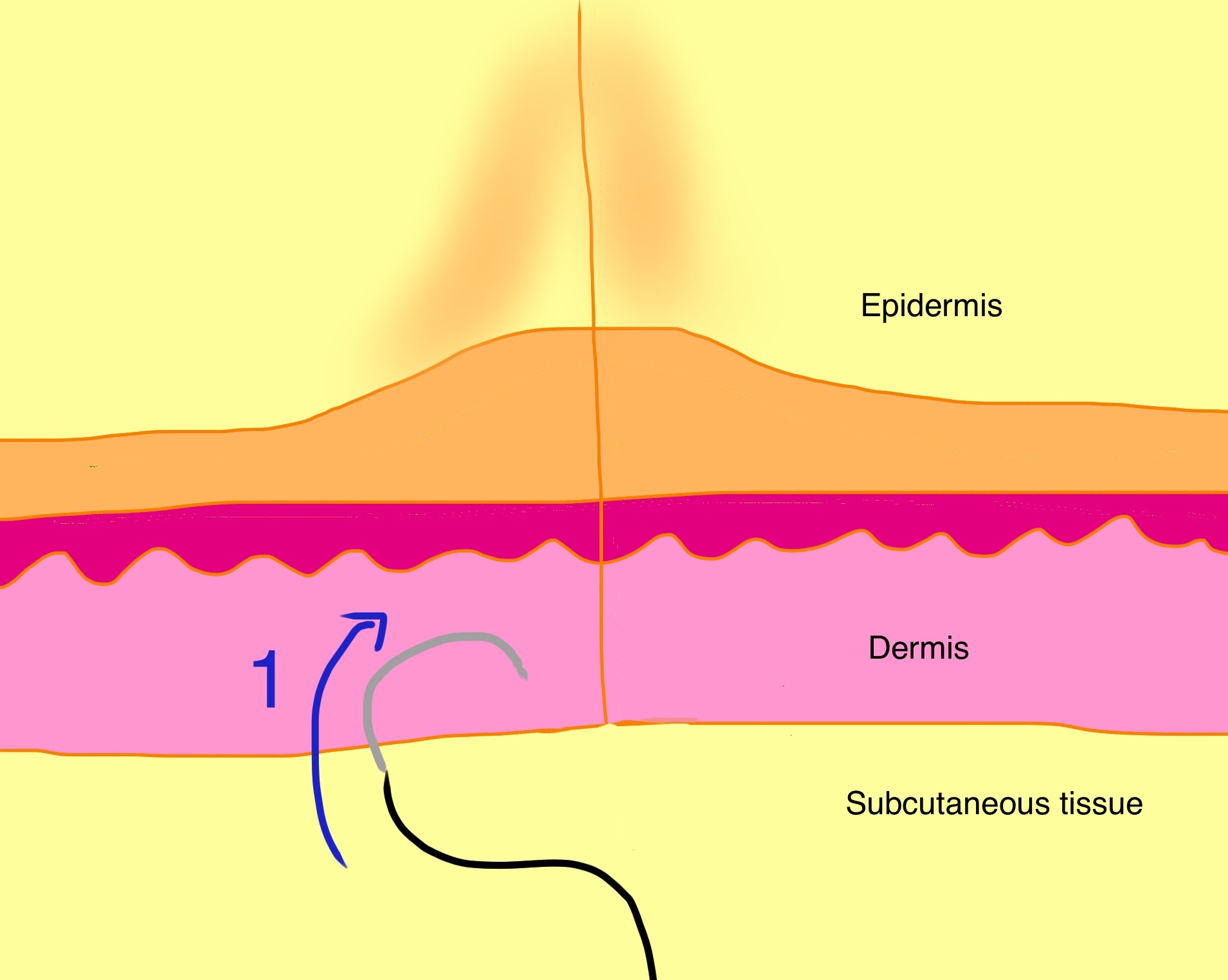 The Set-Back Dermal Suture – Closing the Gap