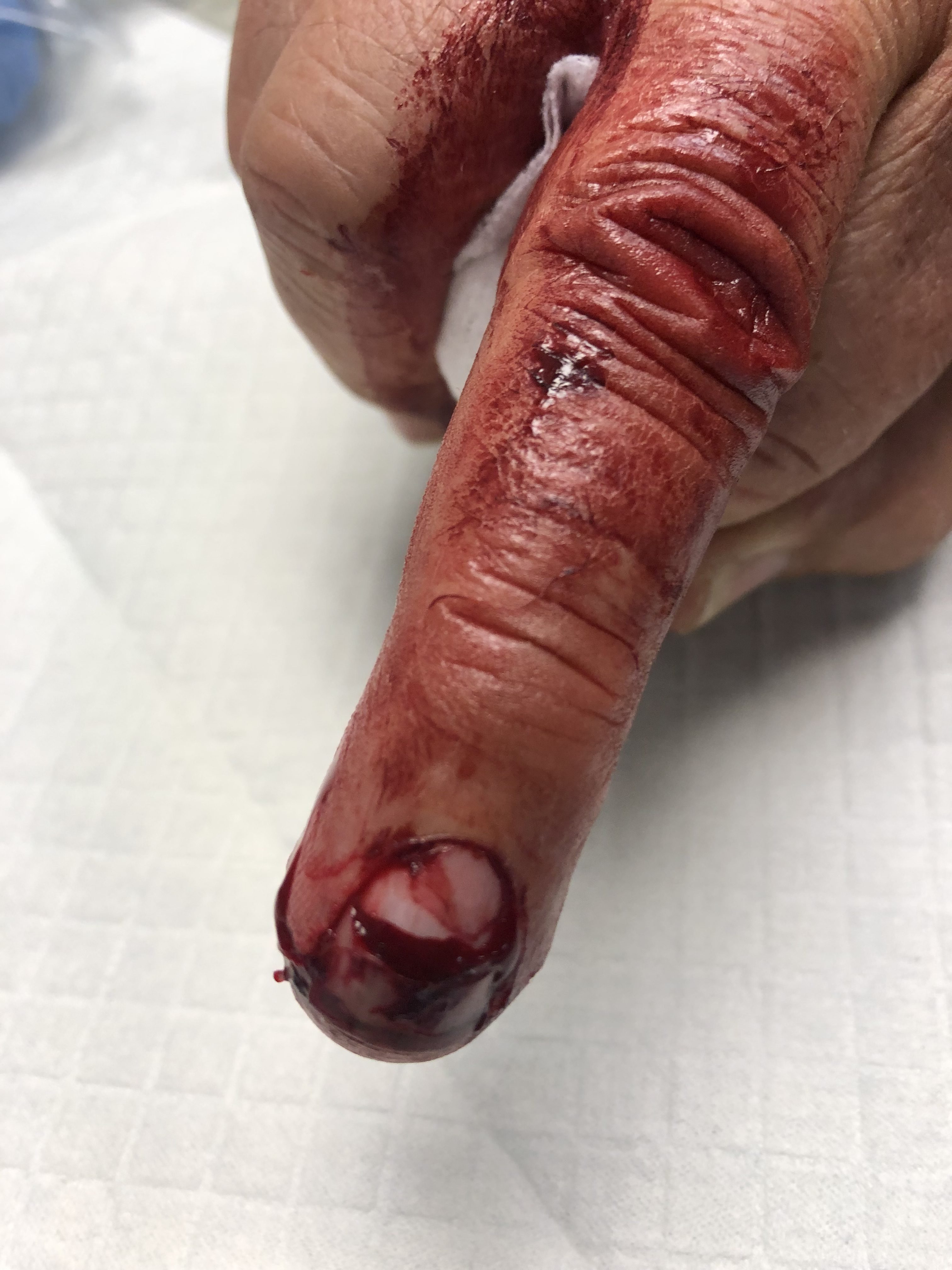 Tuft Fractures, Part I – Closing the Gap