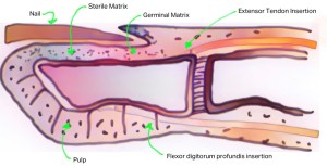 Tuft Fractures, Part I – Closing the Gap