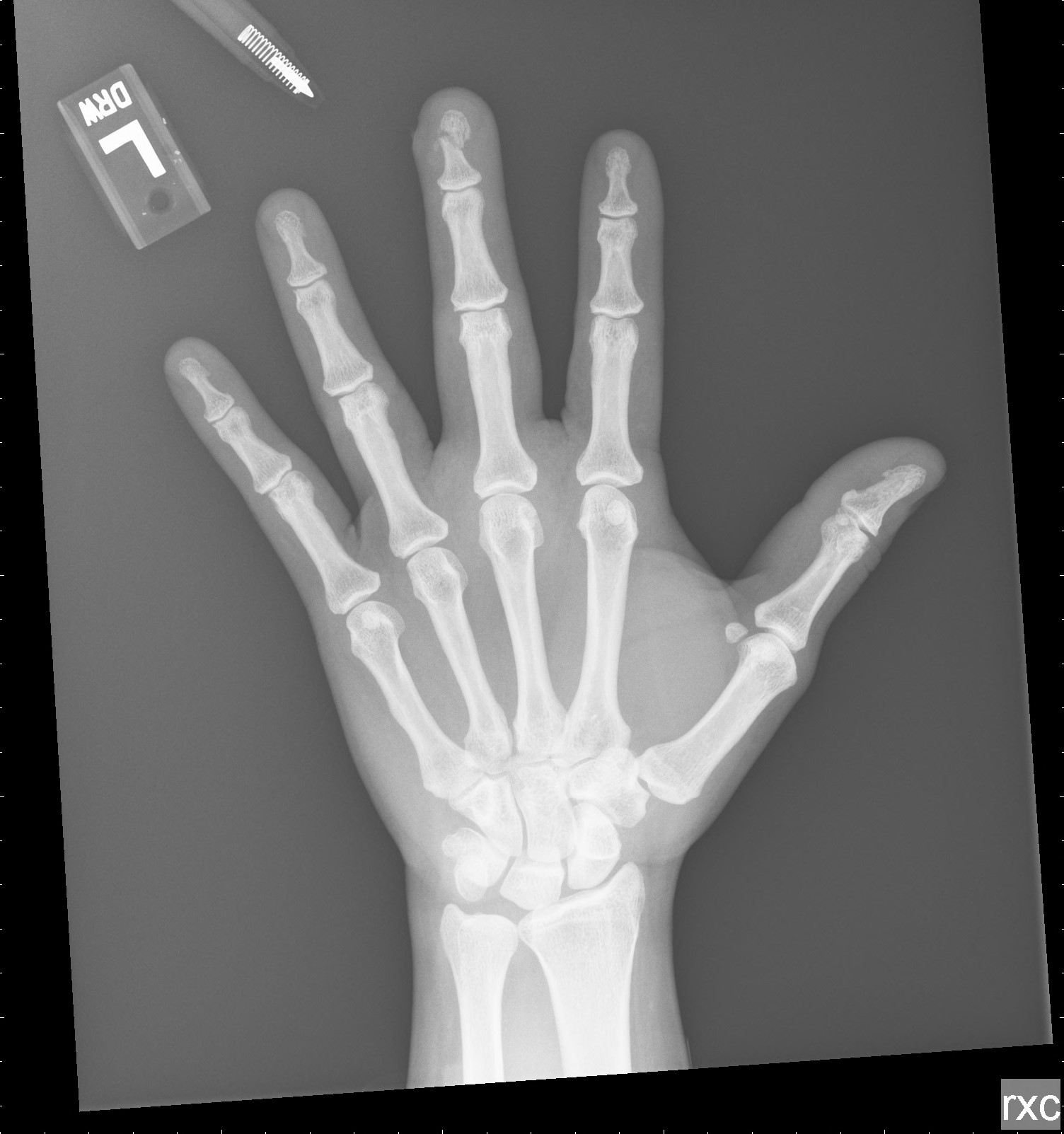 Tuft Fractures, Part I – Closing the Gap